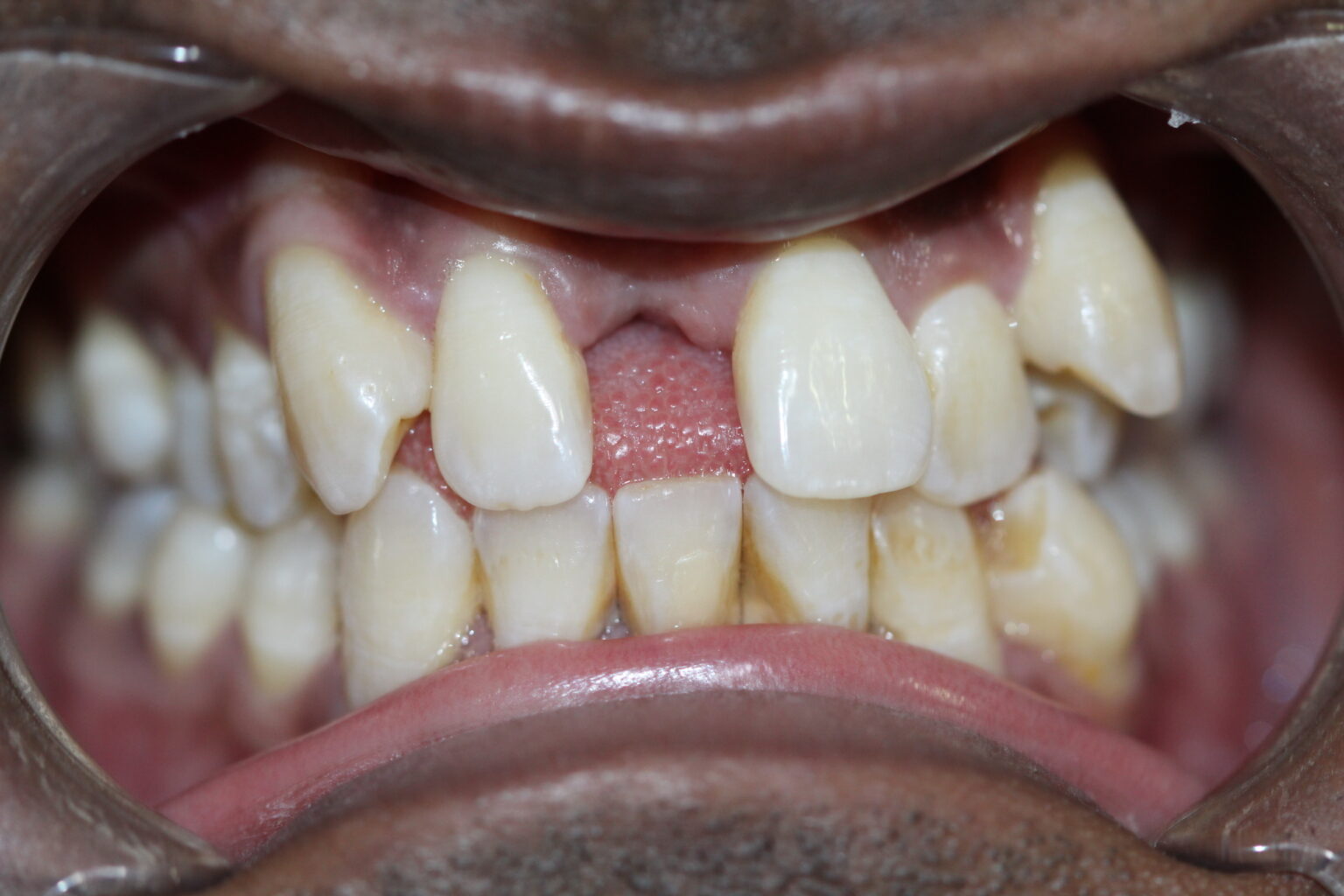 Maryland Bridge – Apa Anda Perlu Tahu?