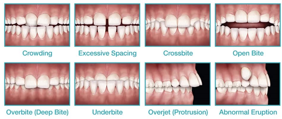 Ketahui Jenis Gigi Yang Boleh Pakai Braces? - Artisan Dental