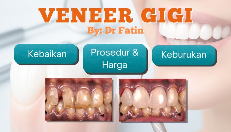 Veneer Gigi: Kebaikan, Keburukan, Prosedur dan Harga - Artisan Dental
